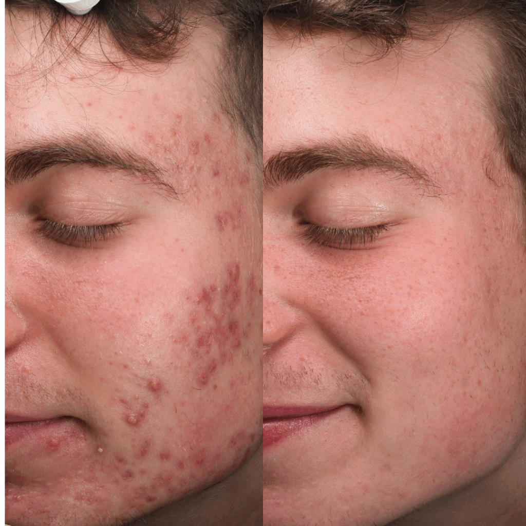 FEALS BBL for Acne, Sydney Northern Beaches